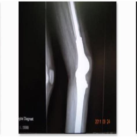 An 18 Year Old Female With Proximal Tibia Ewings Sarcoma Download Scientific Diagram