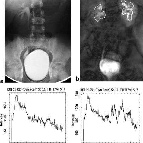 Post­resection Cystogram Demonstrating Contracted Bladder And Grade V