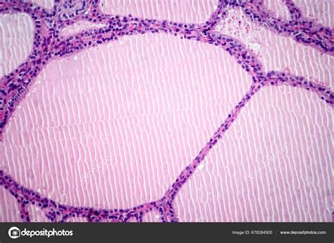 Photomicrograph Endemic Goiter Tissue Sample Microscope Revealing