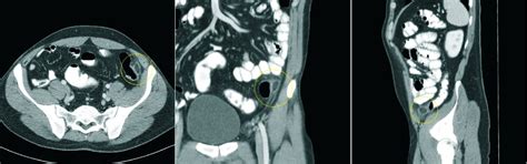 Appendagitis • Litfl • Gastrointestinal Gutwrencher