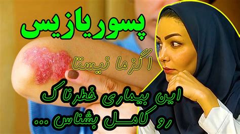 بیماری پسوریازیس یا صدفک Psoriasis Youtube
