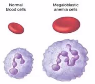 Anaemia Pathophysiology Flashcards Quizlet