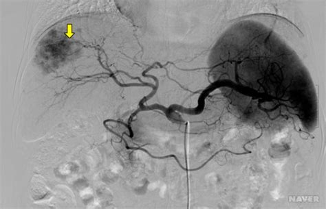 간암 화학색전술 네이버 블로그