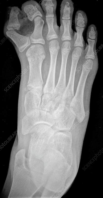 Extra Toe X Ray Stock Image F0367470 Science Photo Library