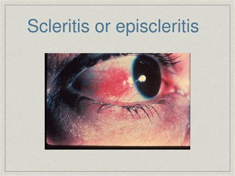 Ppt Essentials Of Ophthalmology Powerpoint Presentation Id22855
