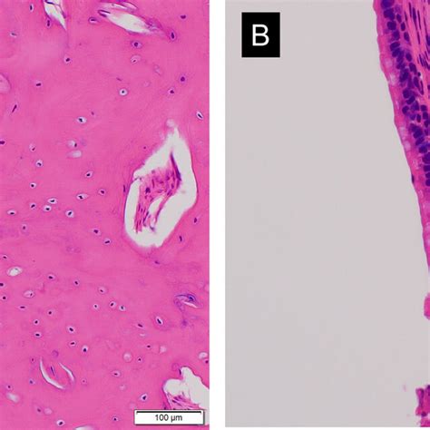Hematoxylin Eosin Staining Of The Tumor A Hematoxylin Eosin