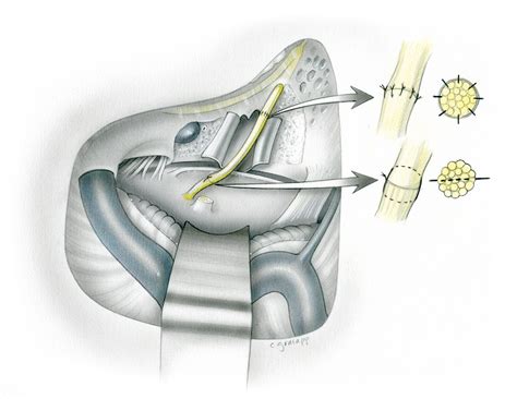 Facial Nerve Repair Skull Base Surgery Atlas