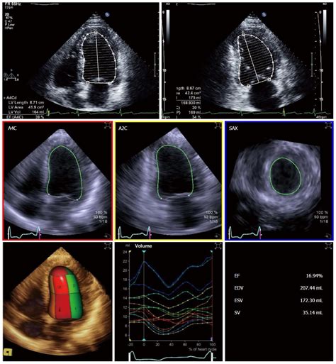 Ejection Fraction Simpsons Method At Jenny Abate Blog