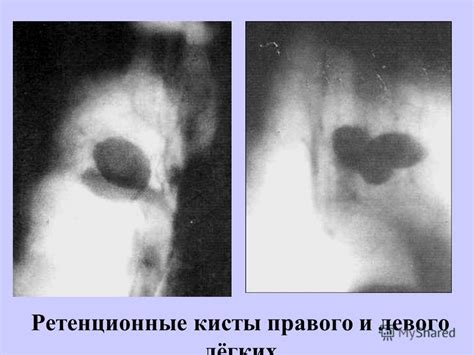 Киста легкого симптомы лечение и народные средства