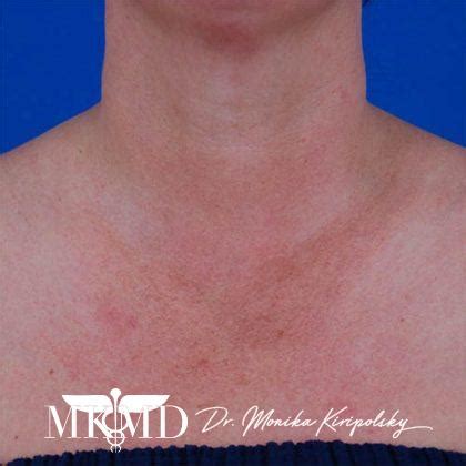 Patient 796 Diffuse Redness Before And After Photos Beverly Hills CA Plastic Surgery Gallery