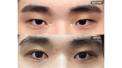 [무보정전후영상] 남자눈성형 속쌍꺼풀 몽고주름 제거 절개눈매교정 앞트임 3개월 Youtube