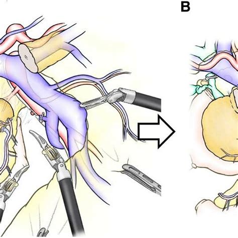 Schema Of The Right Position A The Proximal Jejunum Is Divided And Download Scientific