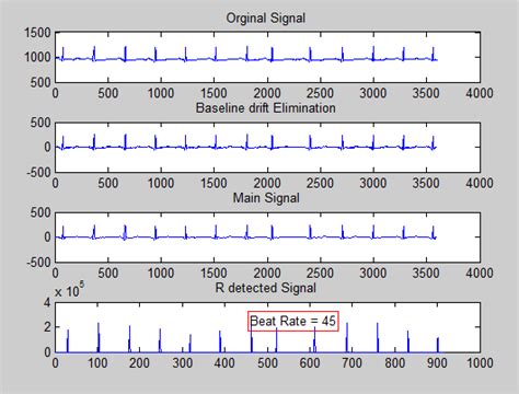 captured ecg signal [11] download scientific diagram