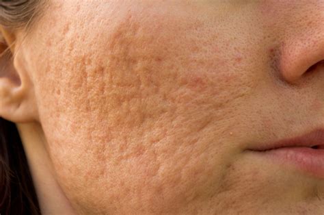 How Acne Scars Fade