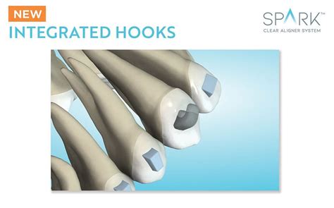 Spark Clear Aligners Release 13 Delivers Orthodontic Innovations With