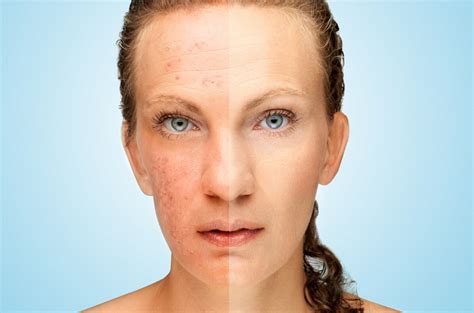 Selenium For Acne Secret Weapon For Skin Health Anirva