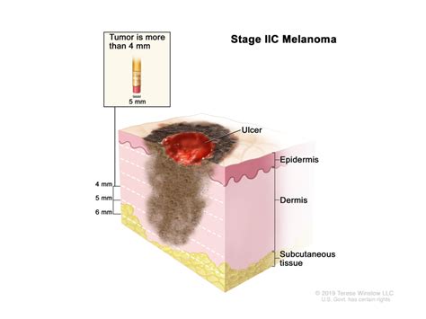 Stage 2 Melanoma Diagnosis Xpertpatient