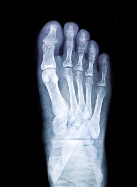 Images De Chirurgie Hallux Valgus Téléchargement Gratuit Sur Freepik