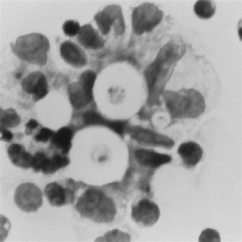 India Ink Examination Of Csf Demonstrating The Heavily Encapsulated Download Scientific