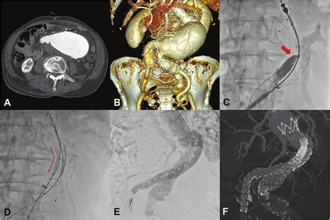 A B Ct Showed Abdominal Aorta Aneurysm With Severely Angulated Download Scientific Diagram
