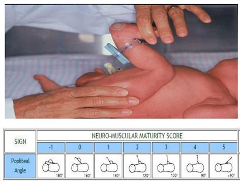 Gestational Age For Neonates By Ballard Scorepptx