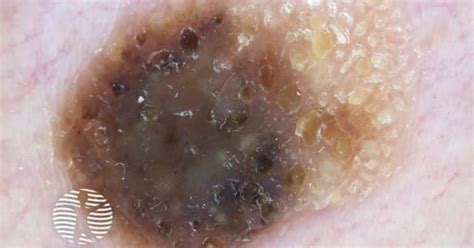 Seborrhoeic Keratosis Dermoscopy Image