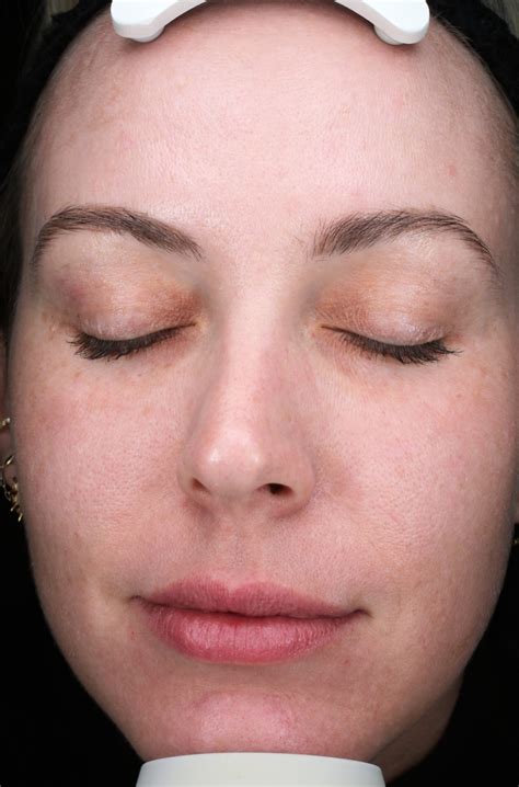 Moxi 21 Aestheticare Aestheticare