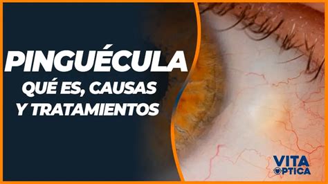 LUPAS Definición y características Vita Óptica