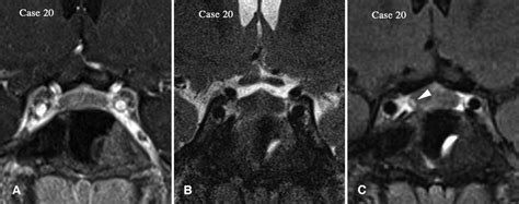 Volumetric Spoiled Gradient Recalled Acquisition In The Steady State A Download Scientific