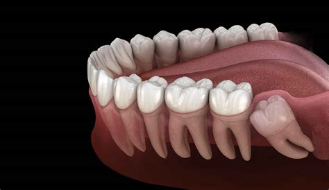 Operculectomy Code E‐poster 2023 Clinical Oral Implants Research