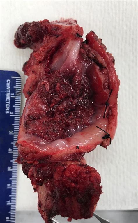 Right Segmental Mandibulectomy With Revised Buccal Mucosal Margin Download Scientific Diagram