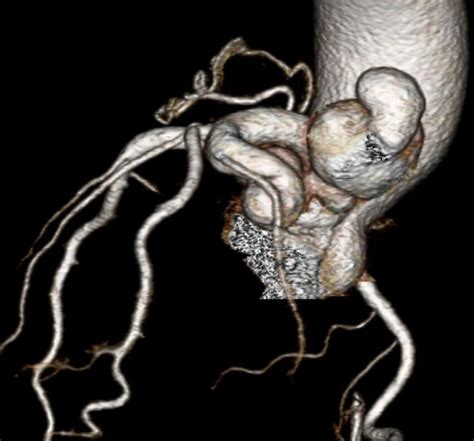 3d Reconstruction From Cardiac Cta Dilated And Aneurysmal Lcx Caf