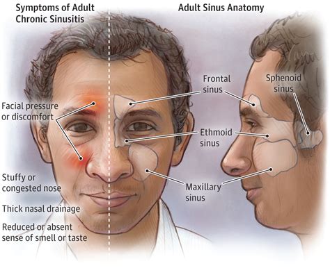 Can Antihistamines Cause Sinus Infections