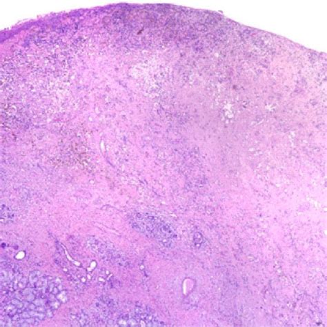 Detail From The Periphery Of The Tongue Sarcomatous Tumor In The