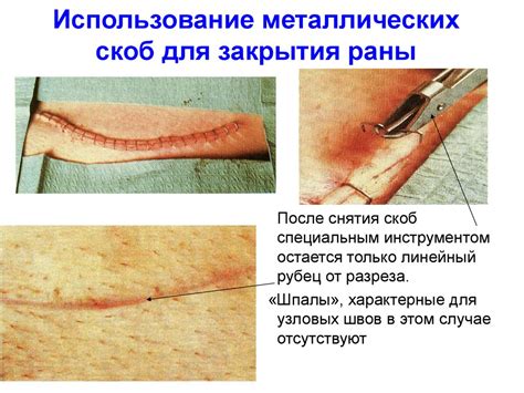 Общая анестезия. Оперативные способы закрытия раневого дефекта ...