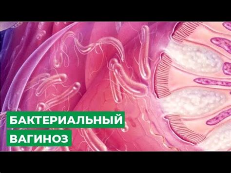 Бактериальный вагиноз причины симптомы и лечение