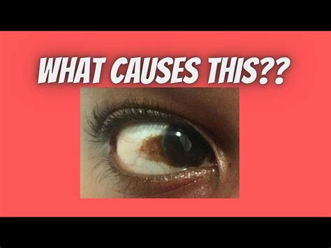 What Causes Brown Spots In Eyes