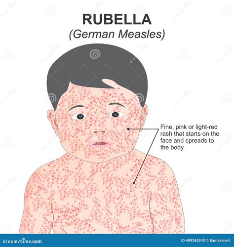 Is Rubella German Measles