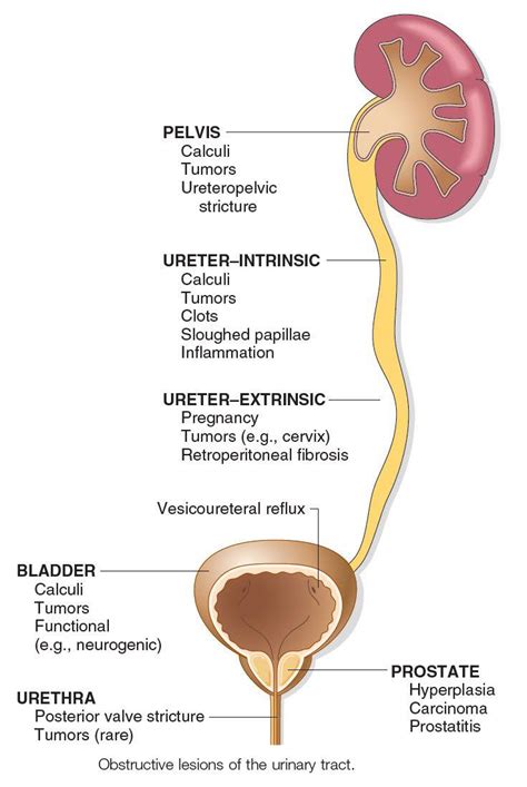 Urology 📕 Obstructive Lesions Of The Urinary Tract Urologynews