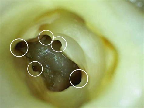 In Practice An Upper First Molar With Four Canals Is Commonly