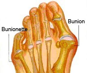 Bunions Bunionettes Identify Your Foot Pain