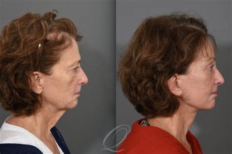 Facelift Before And After Photos Patient 1001547 Serving Rochester