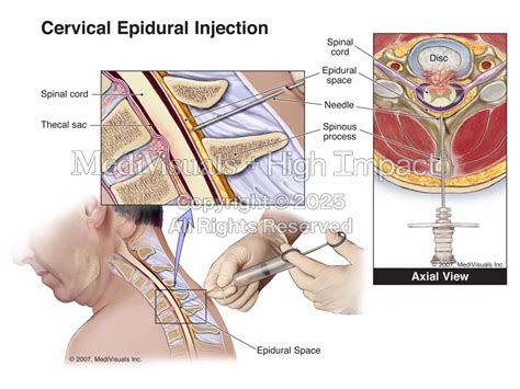 Cervical Epidural Injection Medivisuals High Impact