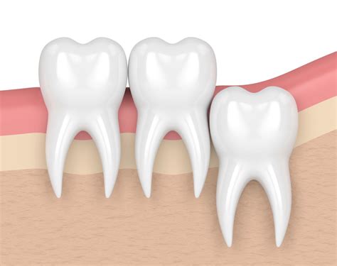 Wisdom Teeth Removal Dentists Co