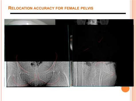Clinical Quality Assurance In Radiotherapy PPTX