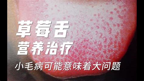 草莓舌的营养治疗 Youtube