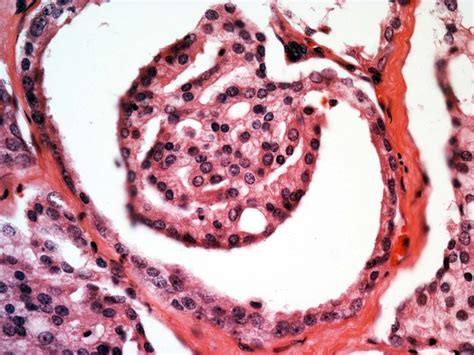 Researchers Identify Promising New Drug Target For Lethal Prostate
