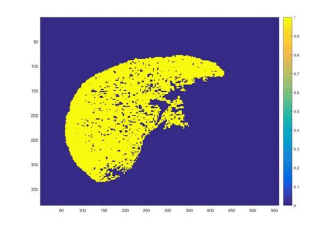 Matlab Image Segmentation For Liver Stack Overflow