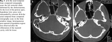 A In The Axial Temporal Bone Computed Tomography Scan The Left Download Scientific Diagram