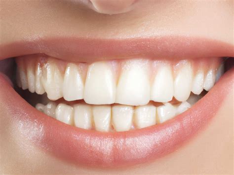 How To Fix A Gummy Smile Dentique The Dental Studio